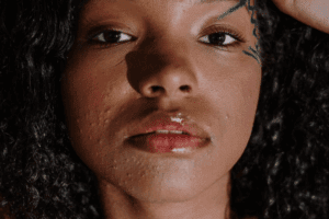 Small White Bumps on Your Face? A Guide to Closed Comedones – Acne Club