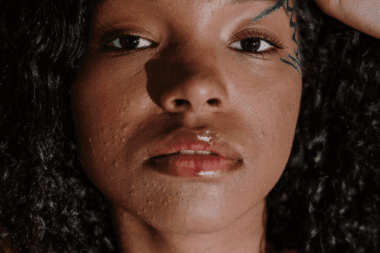 Small White Bumps on Your Face? A Guide to Closed Comedones – Acne Club