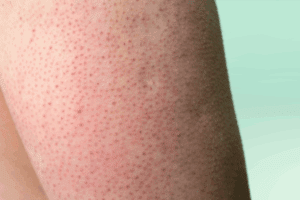 Small Pimples on the Back of Your Arms? All About Keratosis Pilaris ...