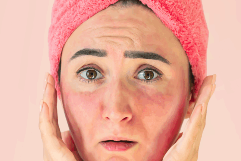 What is Acne-Prone Skin? A Closer Look at This Skin Type – Acne Club